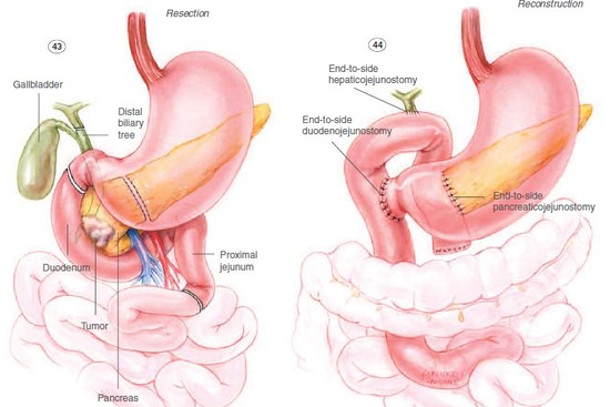 Pylorus Preserving Whipple Procedure