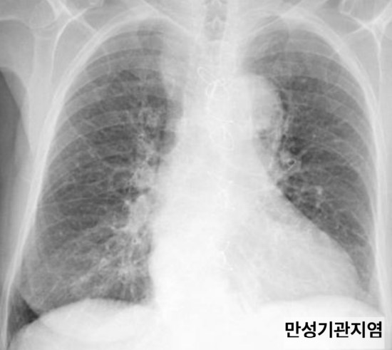만성기관지염 폐면역력을 높여야 한다 네이버 블로그