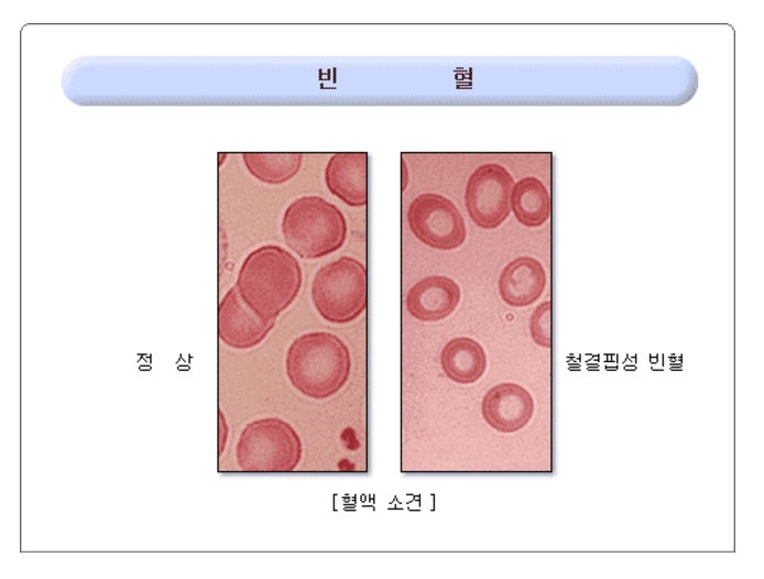 건강검진 결과 빈혈 혈색소 수치가 낮을때 네이버 블로그