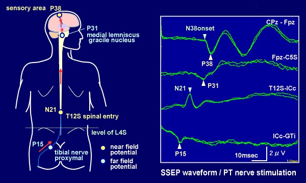 체성감각유발전위 - SSEP, Short latency Somatosensory Evoked Potential : 네이버 블로그