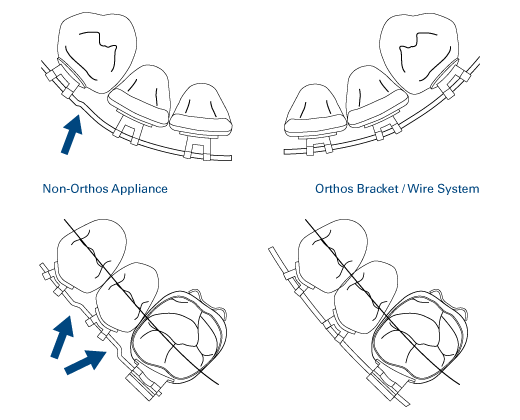 브라켓의 역사(basics of edgewise) : 네이버 블로그