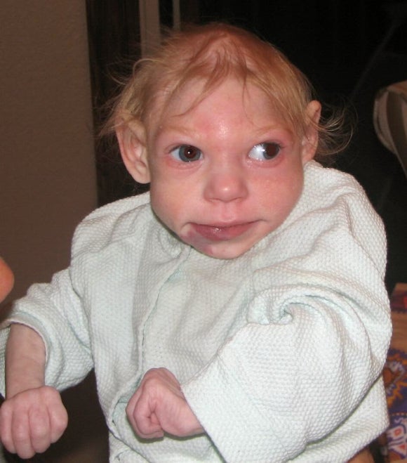 소두증(Microcephalia)이란 무엇일까? : 네이버 블로그