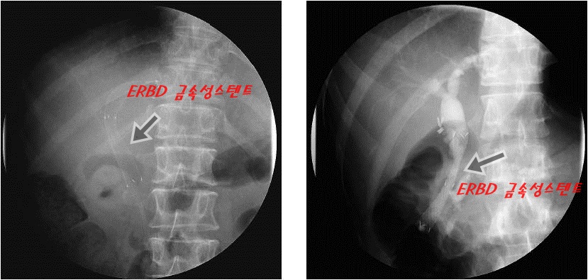 ERCP; 내시경적역행성담췌관조영술, 담석제거, ERBD, ENBD : 네이버 블로그