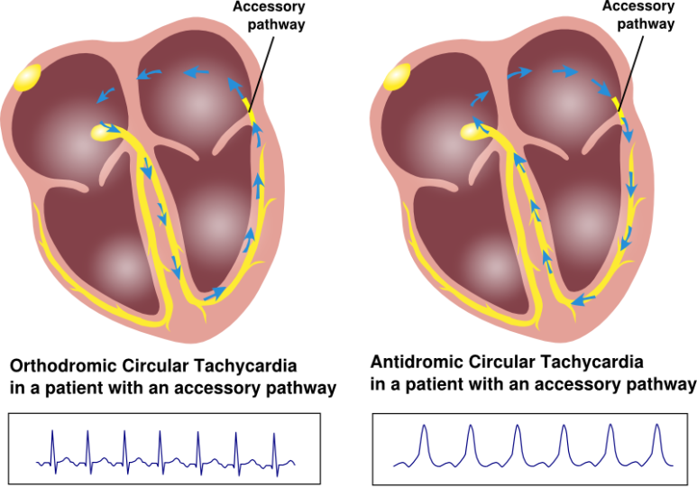 PSVT, AV reentrant tachycardia(AVRT), 조기흥분증후군(Preexcitation syndrome ...